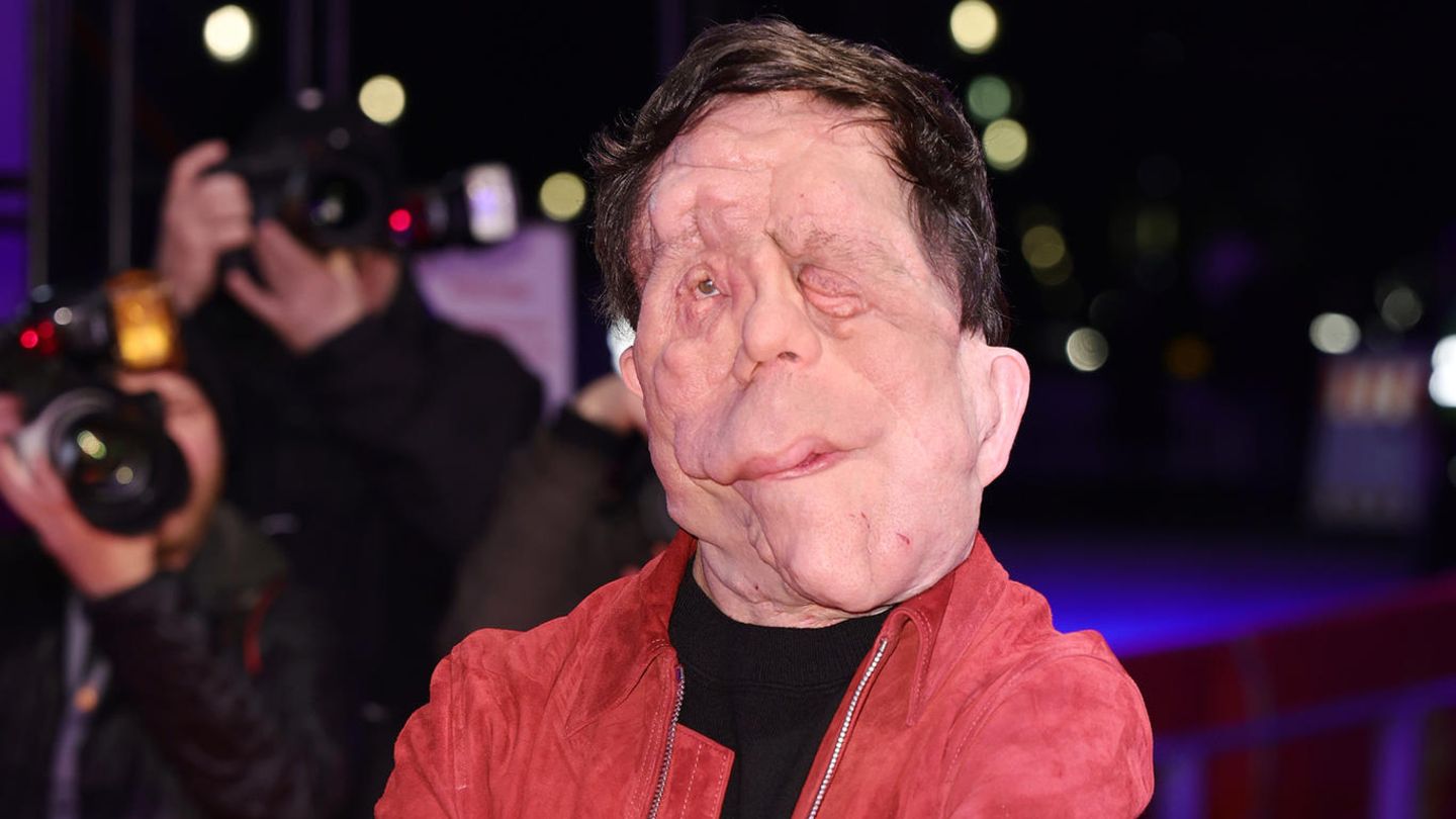 Entstellter Berlinale-Star: Adam Pearson begeistert bei Premiere | GALA.de