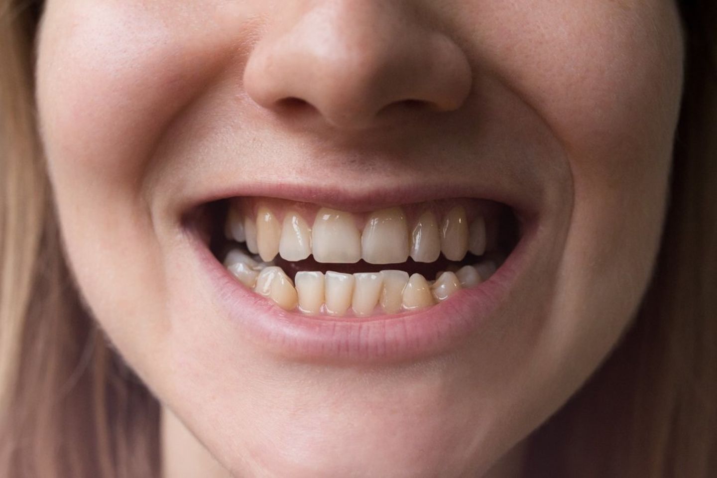 Zahnmediziner klärt auf: Darum werden Zähne gelb und schief | GALA.de