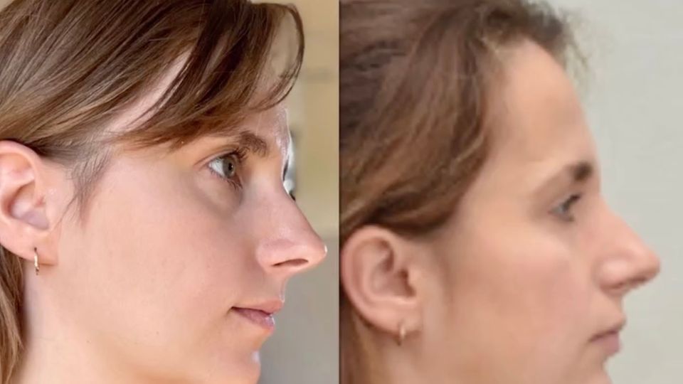 Anna Heiser: Nasen-OP! Doch vorher räumt sie mit den Gerüchten auf ...