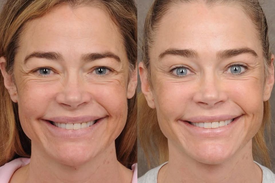Denise Richards zeigt ihre heftige Facelift-Verwandlung | GALA.de